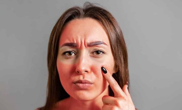 12 ماسک صورت برای آفتاب سوختگی با خاصیت معجزه آسا مجله اکالا
